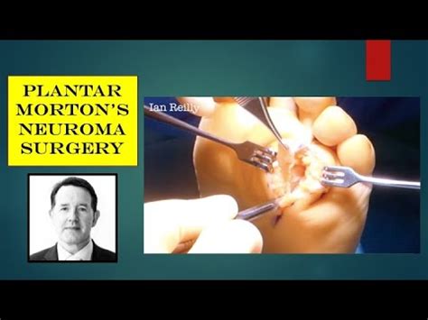 Video Plantar Approach Morton S Neuroma Excision Youtube