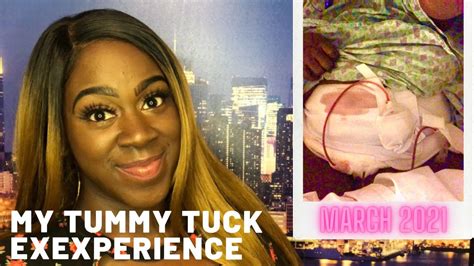 The TRUTH About MY TUMMY TUCK EXPERIENCE BEFORE AFTER PICTURE