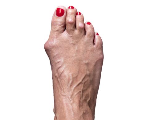 Minimally Invasive Bunion Surgery Arthrex Bunionectomy