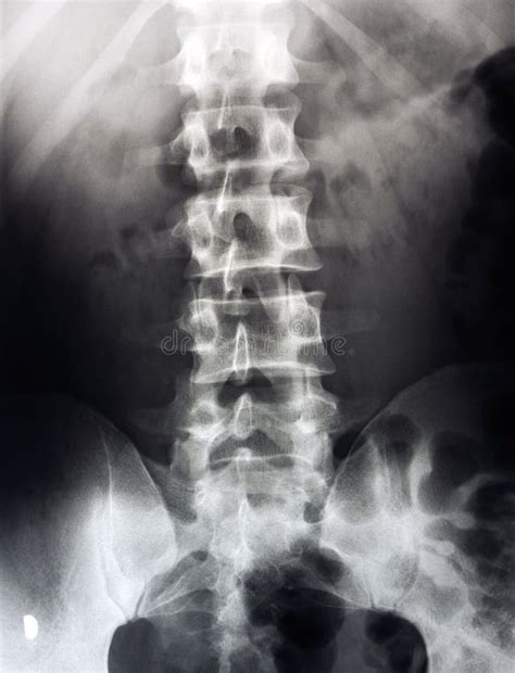 Radiograf A De La Espina Dorsal Lumbar Deformaci N De Espondilosis