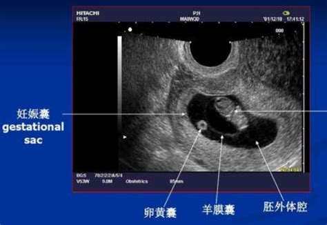孕期B超检查安排表总共做几次孕几周检查查什么很详细 腾讯新闻