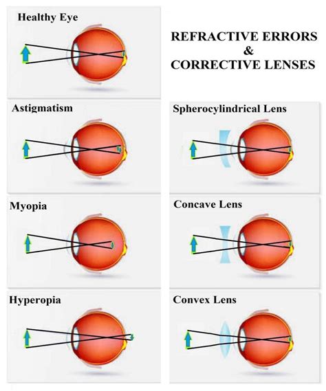 Refractive Errors Thind Eye Hospital