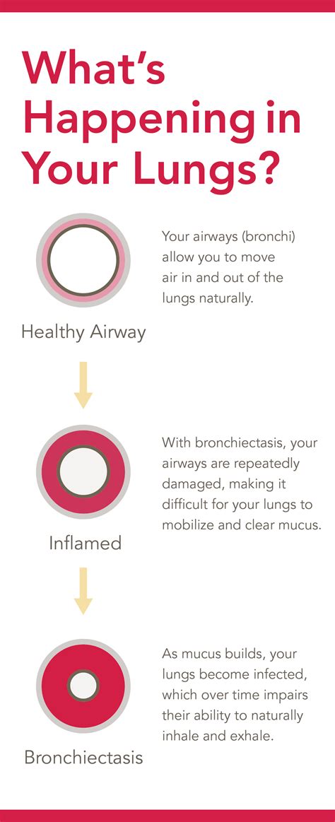 Bronchiectasis Why This Chronic Lung Disease Is Not Well Known