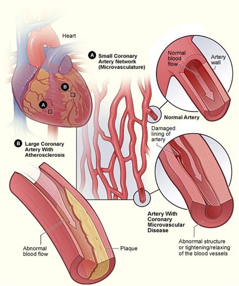 Ischemic Heart Disease National Heart Lung And Blood Institute Nhlbi