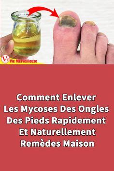 190 meilleures idées sur Soigner mycose pied mycose pied soigner