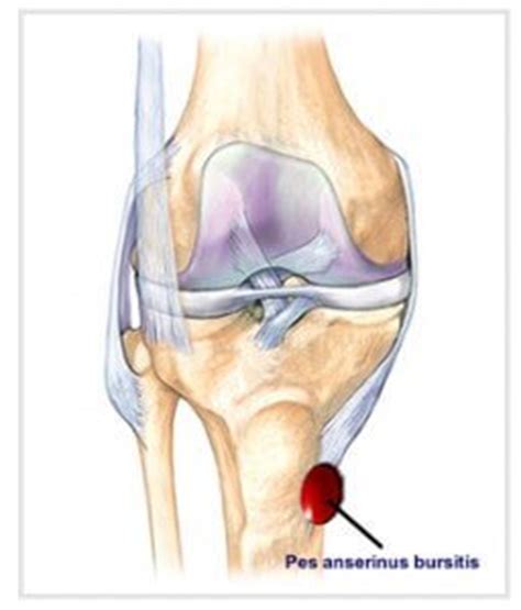 Pes Anserine Bursitis Causes Symptoms Treatment And Prognosis