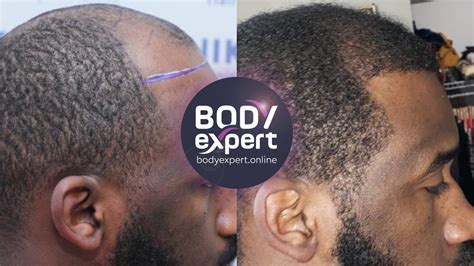 Greffe De Cheveux Afro En Turquie Prix Accessibles Exp Rience Solide