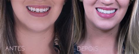 ANTES E DEPOIS LENTE DE CONTATO DENTAL