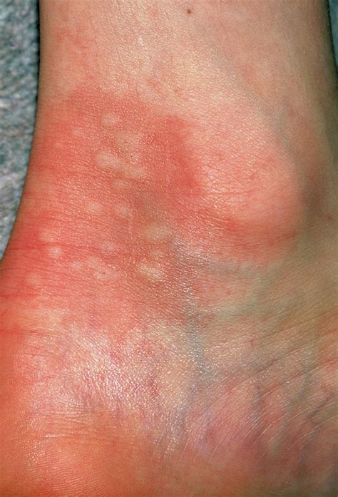 Urticaria Rash Hives On Ankle Due To Nettles Photograph By Dr P Marazziscience Photo Library
