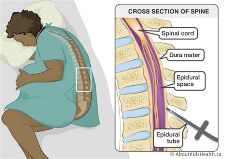 Should I Get An Epidural During Labor NYSORA