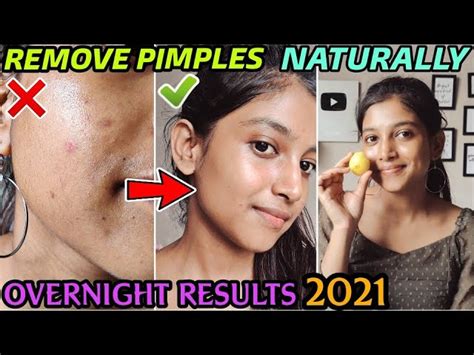 How To Remove Pimples Naturally And Permanently