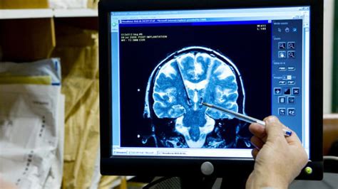 Avance En El Tratamiento De Los Tumores Cerebrales