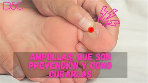 Ampollas en los pies Prevención y tratamiento Clínica Estemedic