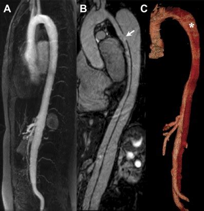 Postpartum Type B Aortic Dissection In Marfan Syndrome The Annals Of