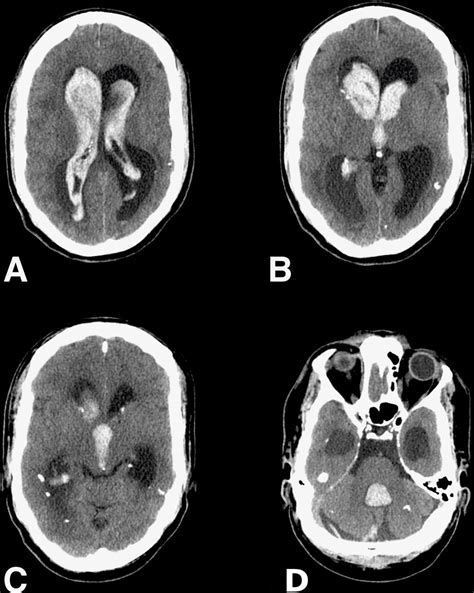 Primary Intraventricular Haemorrhage The Role Of Frontal