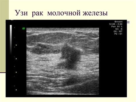 Как выглядит узи при фиброаденоме молочной железы фото презентация