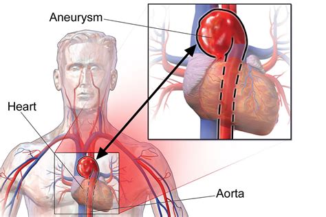 Aortic Aneurysm Abdominal Thoracic Causes Symptoms Repair