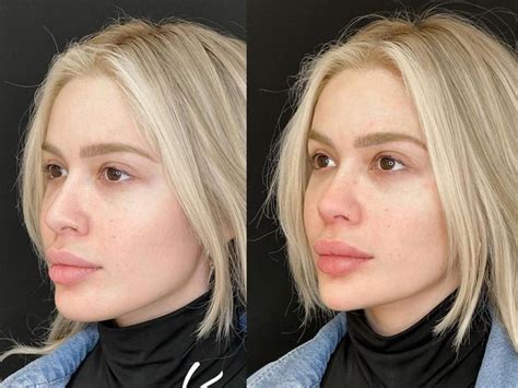 Karoline Lima Tem Dia De Beleza E Mostra Resultado De Procedimentos No