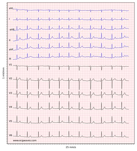 ECG Interpretation Characteristics Of The Normal ECG P Wave QRS