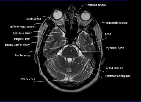 Mri Anatomy Brain Axial Image Brain Anatomy Mri Mri Brain