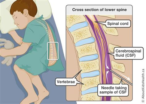 How Is Meningitis Treated Medizzy