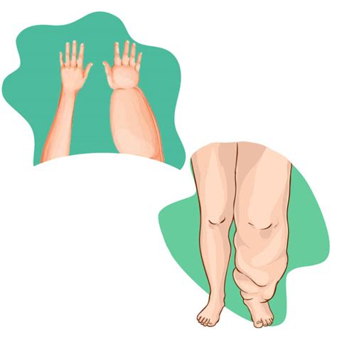 Lymphedema Best Hospital In Salem Multi Speciality Hospital In