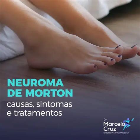 Neuroma De Morton Causas Sintomas E Tratamentos Dr Marcelo Cruz