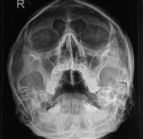 X Ray Paranasal Sinus Demonstrating Bilateral Maxillary Sinusitis