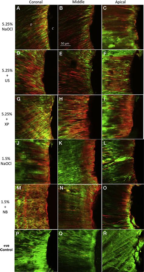 CLSM Analysis Of Live Dead Bacteria In Dentinal Tubules Showing