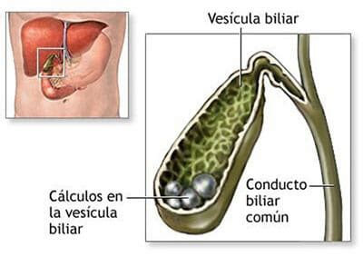Litiasis biliar causas síntomas y tratamiento eSalud