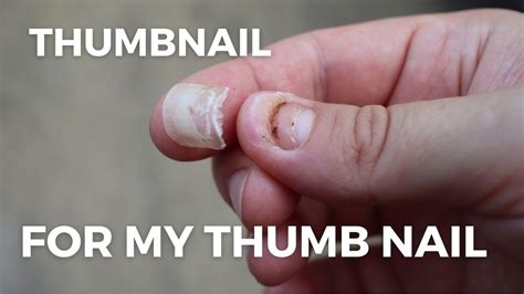 Smashed Nail Falling Off Subungual Hematoma Time Lapse YouTube