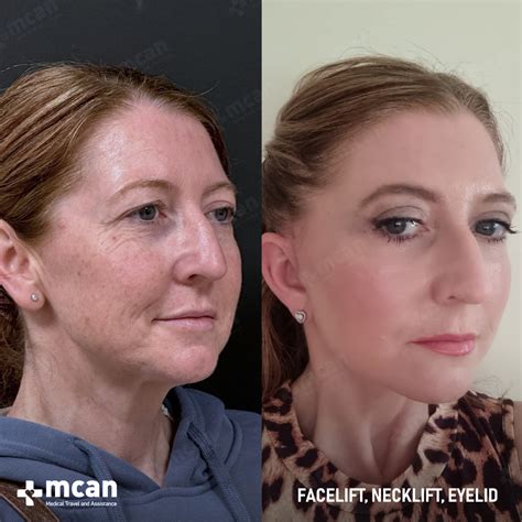Qué Es Exactamente un Método de Lifting Facial de Plano Profundo Lo