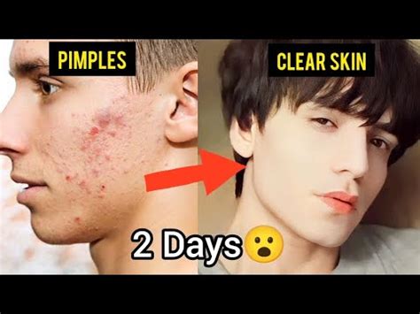 How To Get Clear Skin Just In Days Youtube