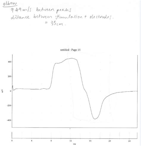 Nerve Conduction Velocity In Motor And Sensory Fibres 1532 Words