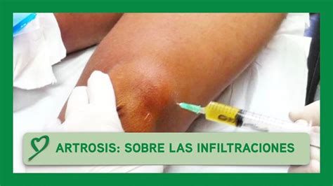 ARTROSIS Sobre Las INFILTRACIONES YouTube