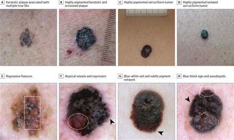 Dermoscopic Clues For Diagnosing Seborrheic Keratosislike Melanomas