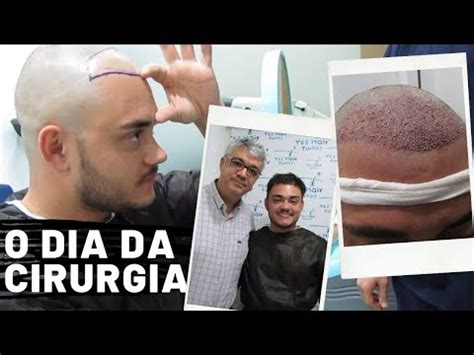 MEU TRANSPLANTE CAPILAR NA TURQUIA YouTube