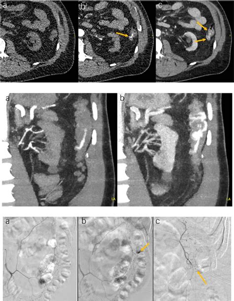 Figure 4 From Management Of Patients With Acute Lower Gastrointestinal