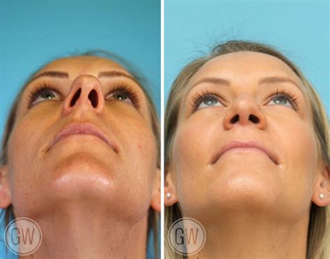 Septoplasty And Turbinate Reduction