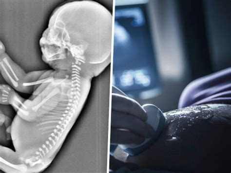 Sirenomelia Syndrome X Ray