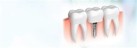 Should You Go For Basal Implants In India Dr Motiwala