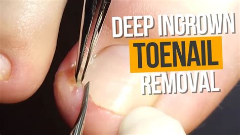 Deep Ingrown Toenail Ingrown Toenail Removal YouTube
