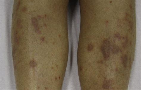 Lichen Planus Dr John Kc
