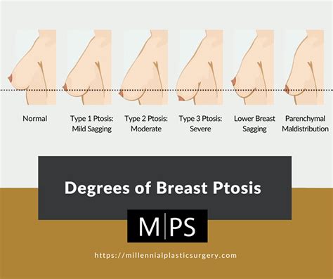 Dicas Essenciais Para Manter A Sa De Dos Seios Explora O Biobeleza