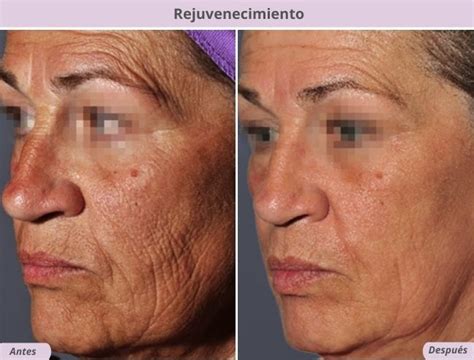 Rejuvenecimiento con láser fraccionado Luzca más joven Clínica