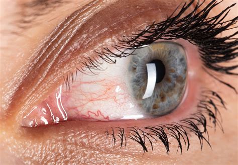La Fatigue Oculaire Retina France