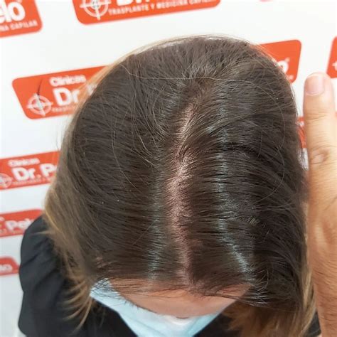 Tratamiento capilar en mujer con MMP Láser capilar LedHair