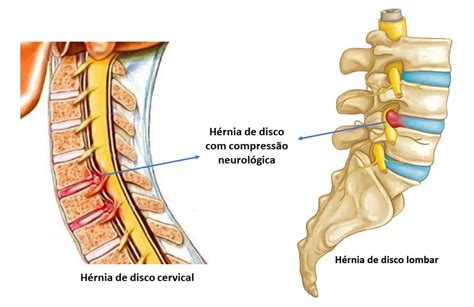 EFEITOS IMEDIATOS DA QUIROPRAXIA NA HÉRNIA DE DISCO CERVICAL ESTUDO DE