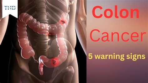 5 Warning Signs Of Colon Cancer You Should Never Ignore YouTube