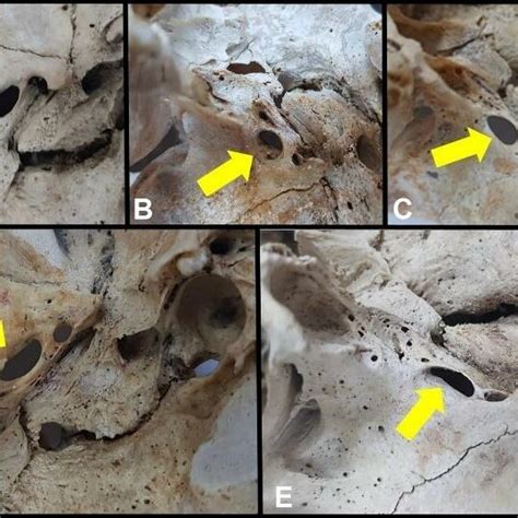 Pdf Anatomical Dimensions And Variances Of The Foramen Ovale In Adult